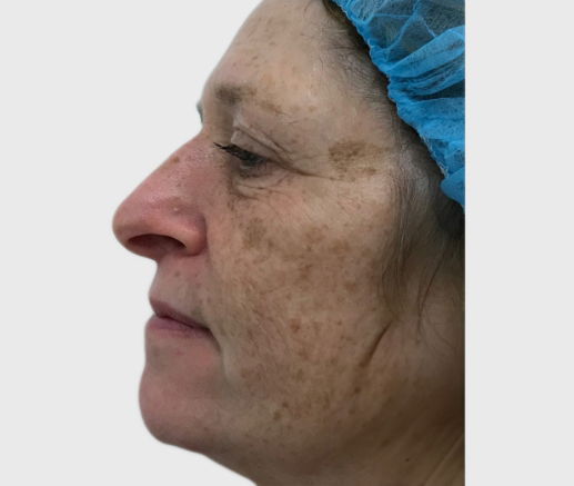 homepage_before_after_before-tablet | Feinstein Dermatology