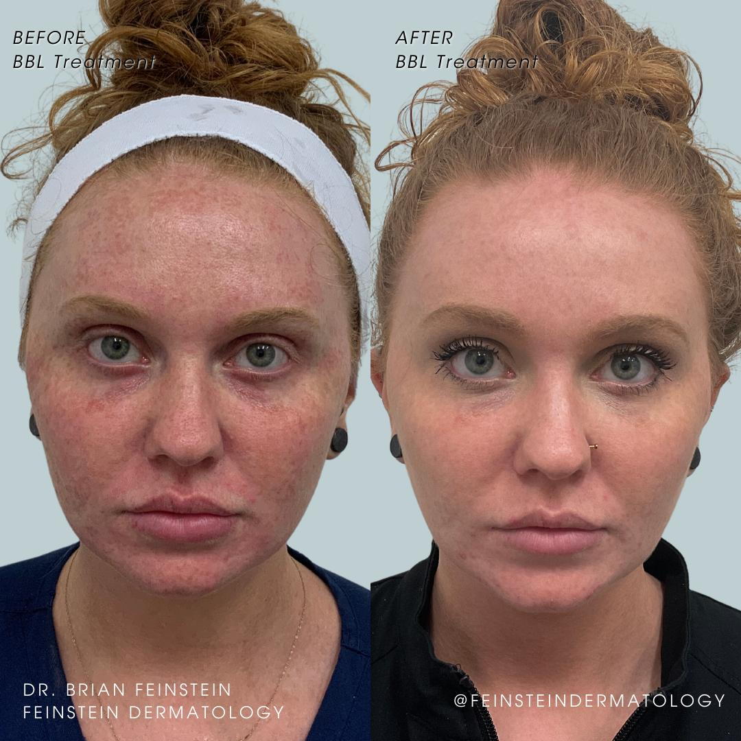 5 Dermatologist-Approved Treatments For Sun-Damaged Skin | Feinstein ...