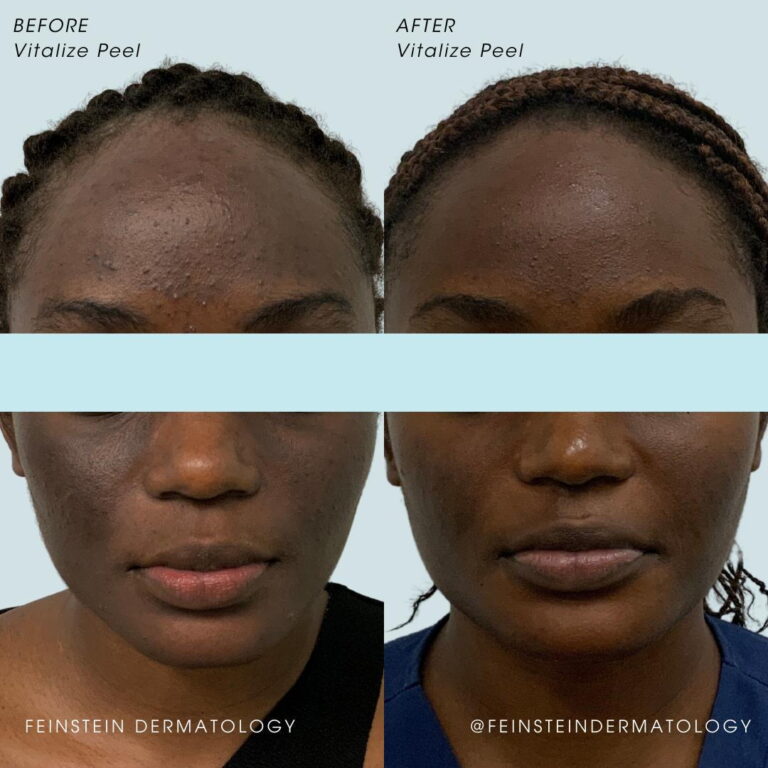 5 Dermatologist-Approved Treatments For Sun-Damaged Skin | Feinstein ...