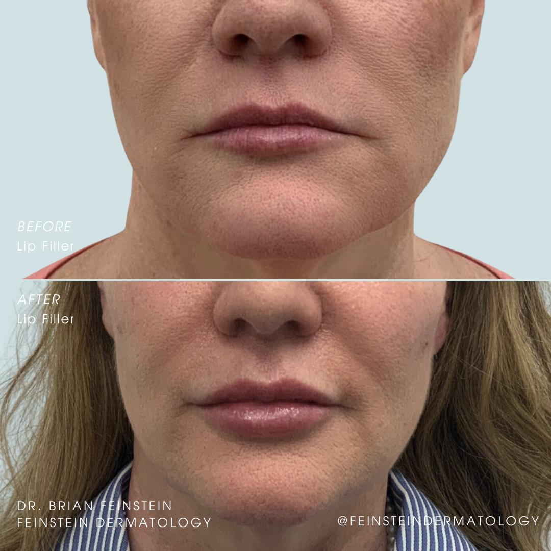 Lip Flip vs Lip Filler: Which Is Right For You? | Feinstein Dermatology