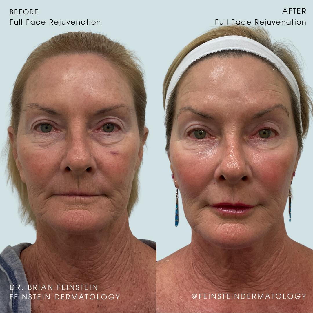 The Art Of Full-Face Rejuvenation | Feinstein Dermatology