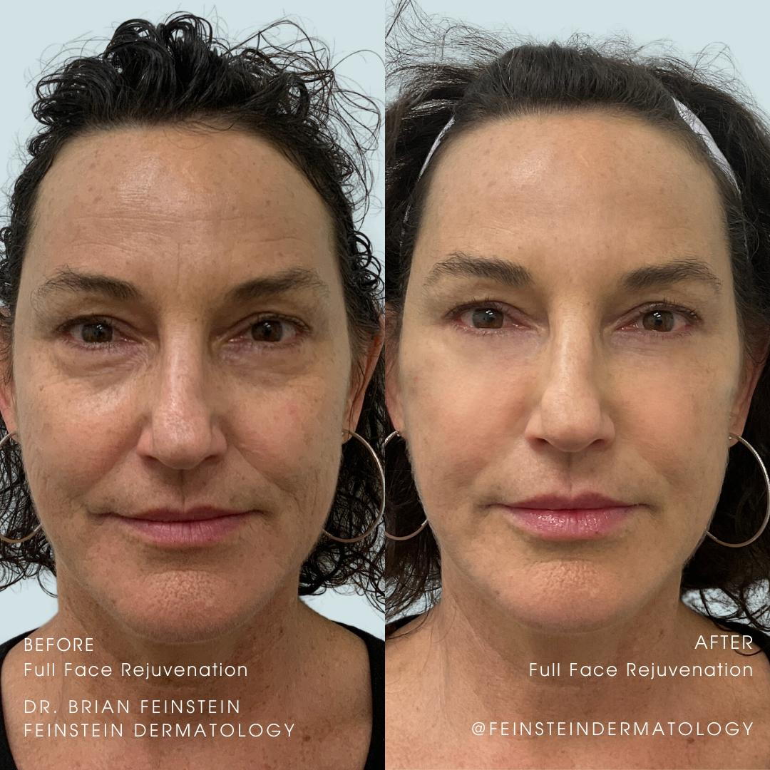 The Art Of Full-Face Rejuvenation | Feinstein Dermatology