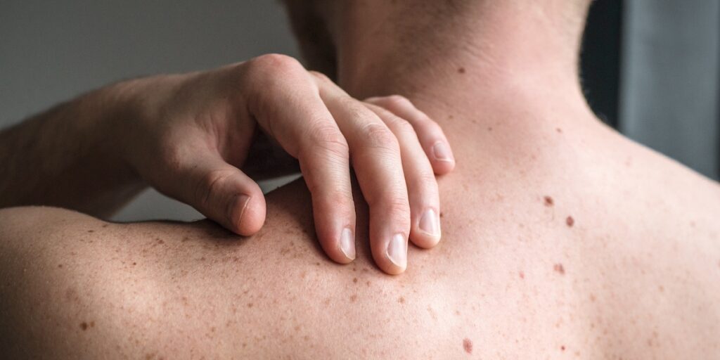 I Found a Suspicious Mole – Now What? | Feinstein Dermatology