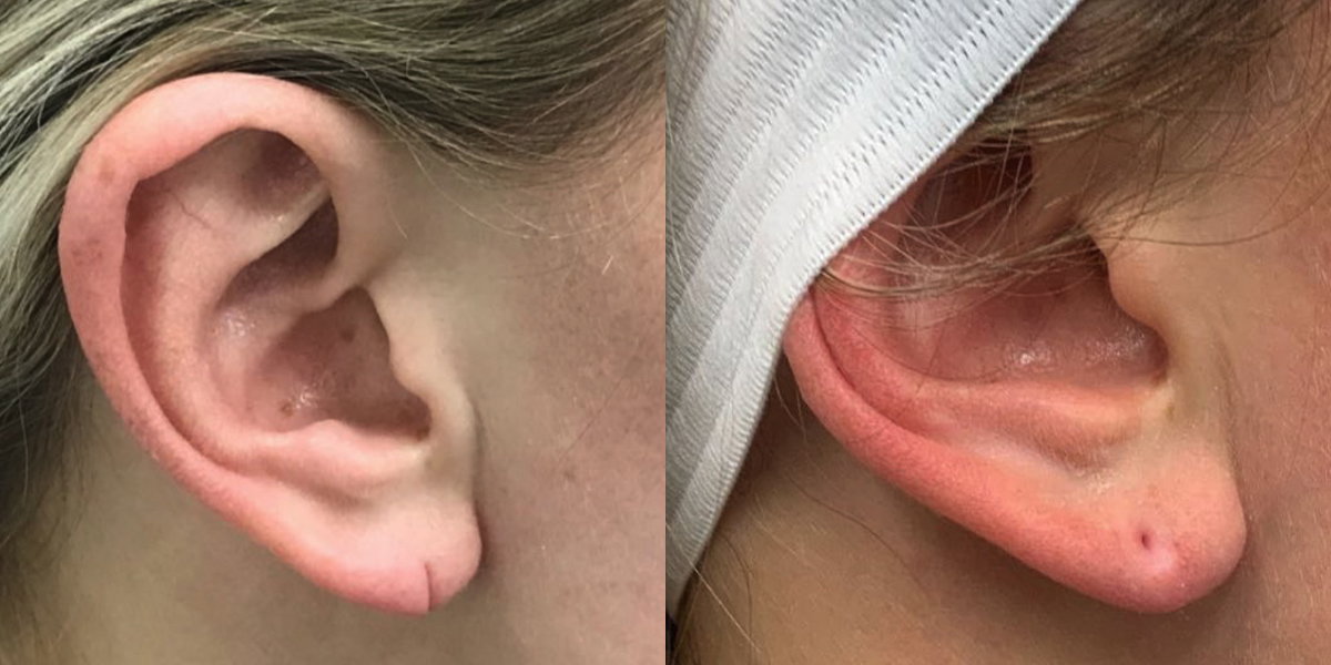 Earlobe Repair Delray Beach | Feinstein Dermatology