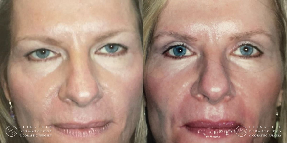 Feinstein_BA_Upper-Bleph-Patient 2a | Feinstein Dermatology