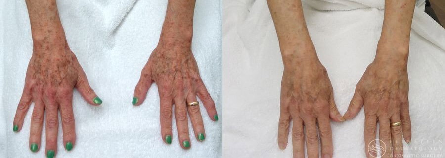 7 Do's and Don'ts of Halo Laser | Feinstein Dermatology